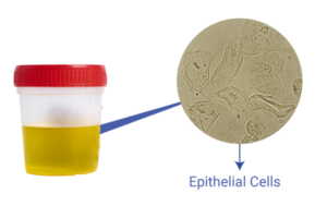 What Epithelial Cells in urine Can Tell You